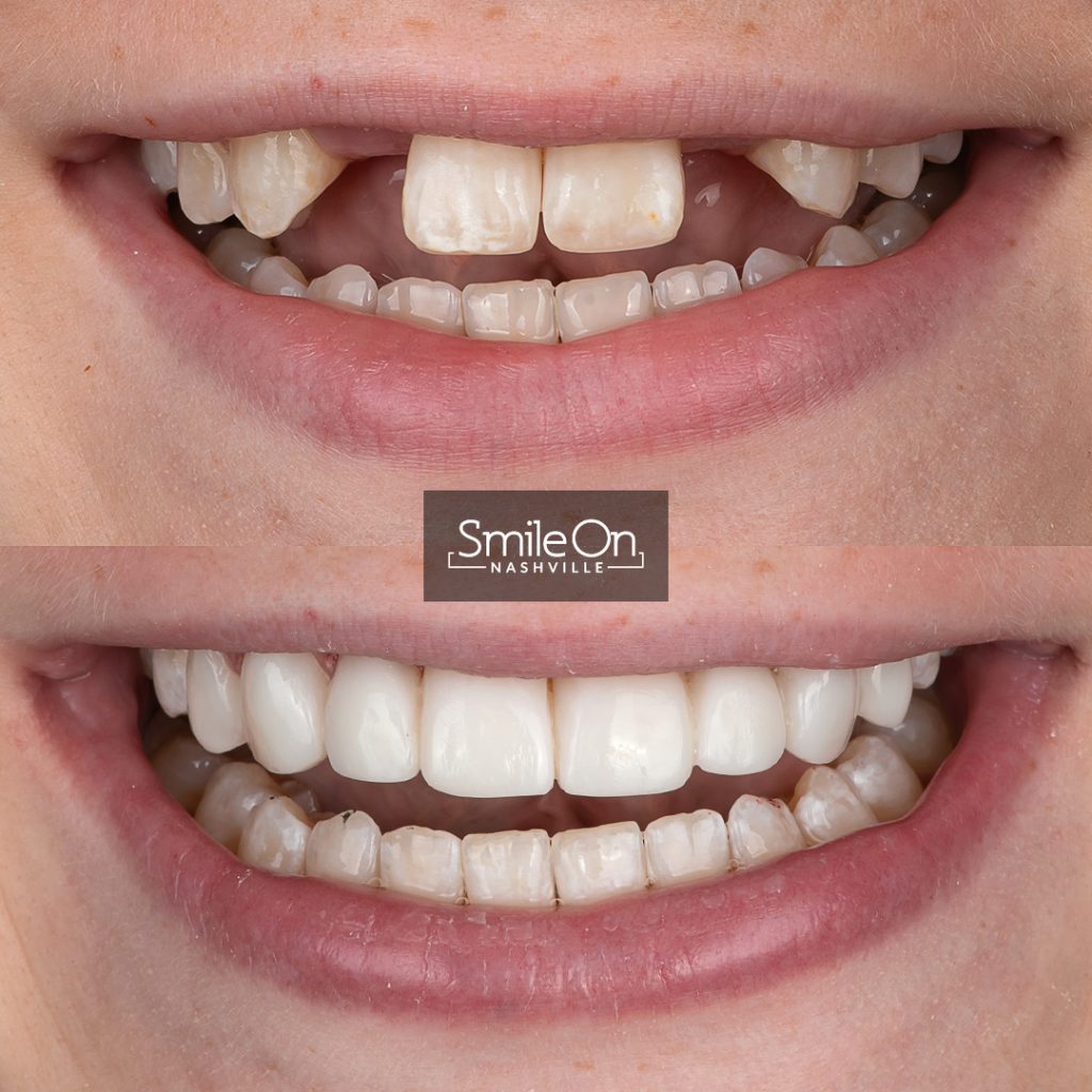 Ribbond Reinforced Resin Bridge – Smile On Nashville