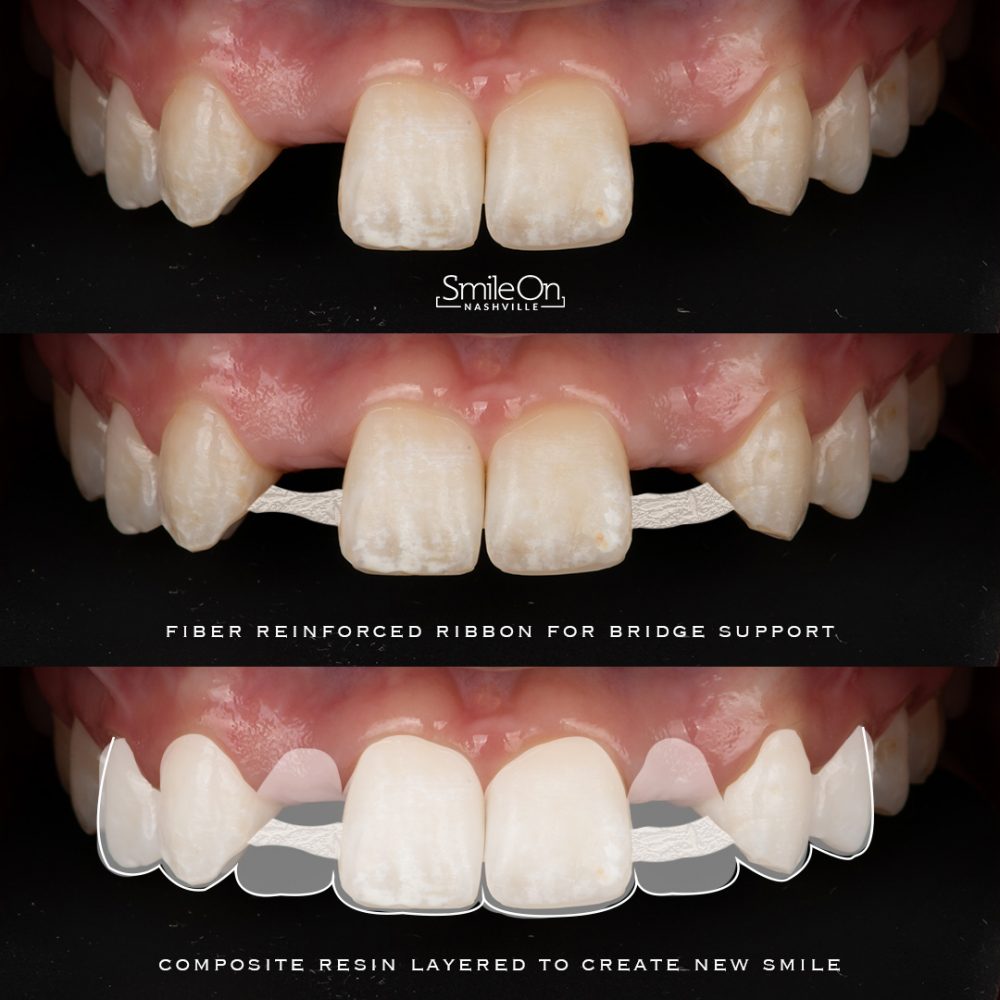 Ribbond Reinforced Resin Bridge – Smile On Nashville