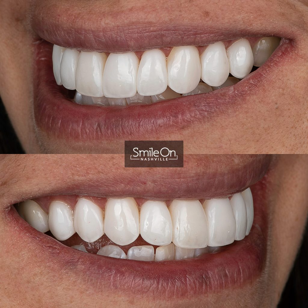 NON-INVASIVE COMPOSITE RESIN – Smile On Nashville