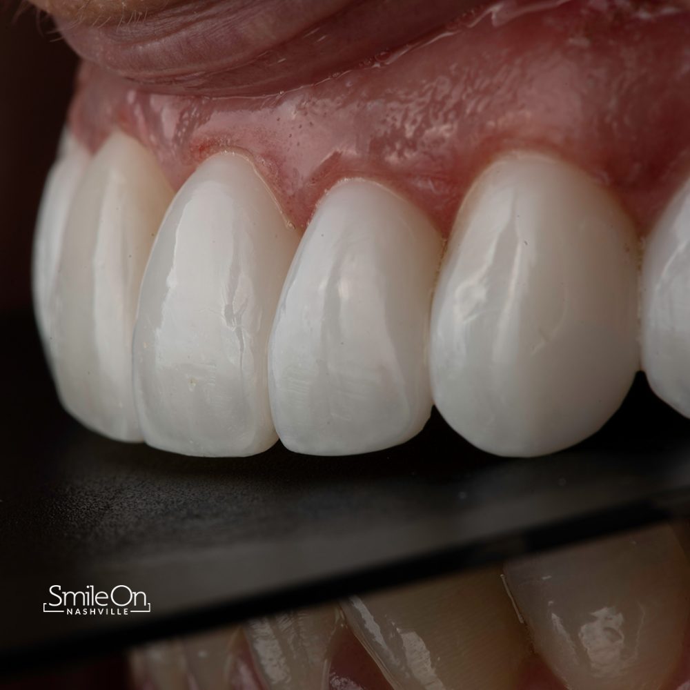 NON-INVASIVE COMPOSITE RESIN - Smile On Nashville